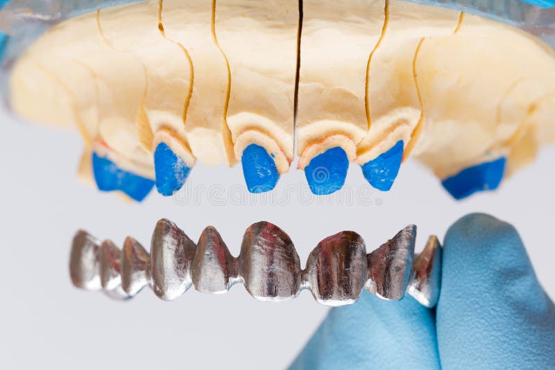 För tand- krona fotografering för bildbyråer. Bild av gummi - 46303131