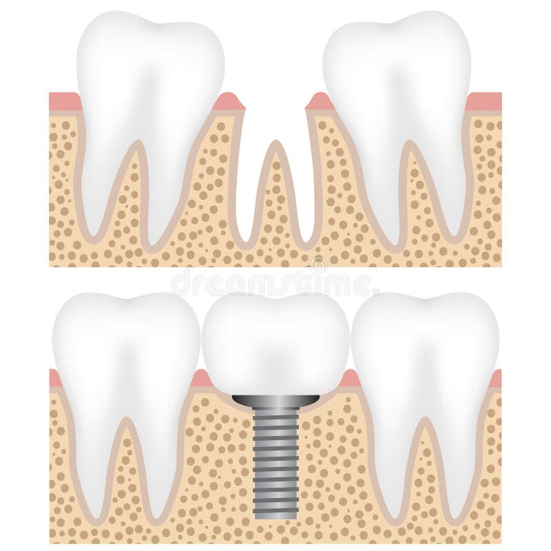 Realistische, Gezonde Tanden En Een Tandimplantaat. Installatie Van Een ...