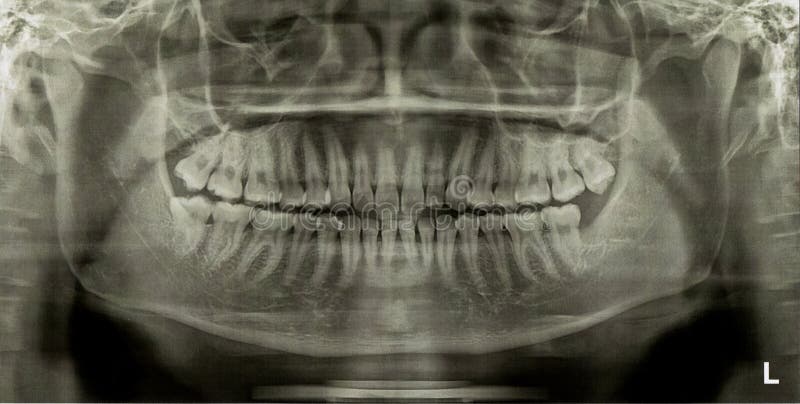 Tand röntgenfoto. stock foto. Image of straling, wortel - 14857220