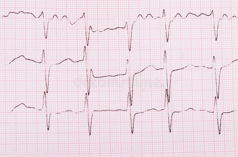 The Tape with the Cardiogram of a Man Stock Image - Image of cardiac ...