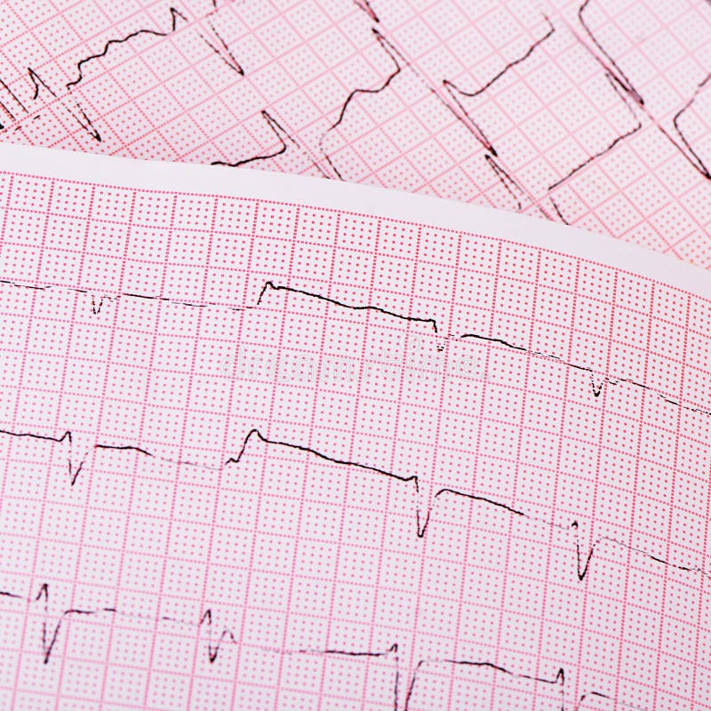 The Tape with the Cardiogram of a Man Stock Image - Image of cardiac ...