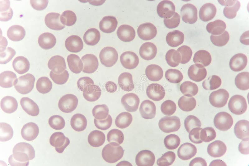 Target Cells With Abnormal Red Blood Cells From Anemia Patient Stock ...
