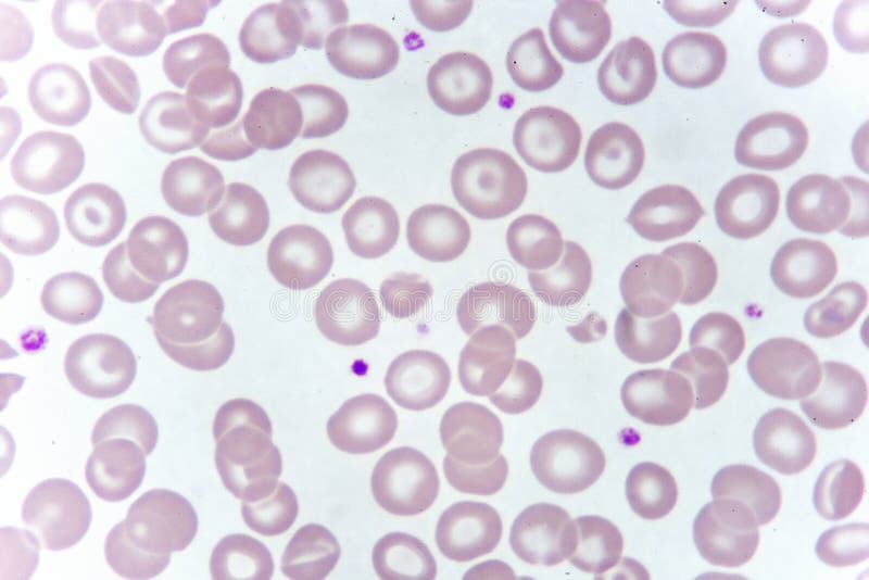 Target Cells with Abnormal Red Blood Cells from Anemia Patient Stock ...
