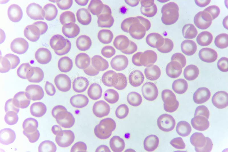 Target Cells with Abnormal Red Blood Cells from Anemia Patient Stock ...