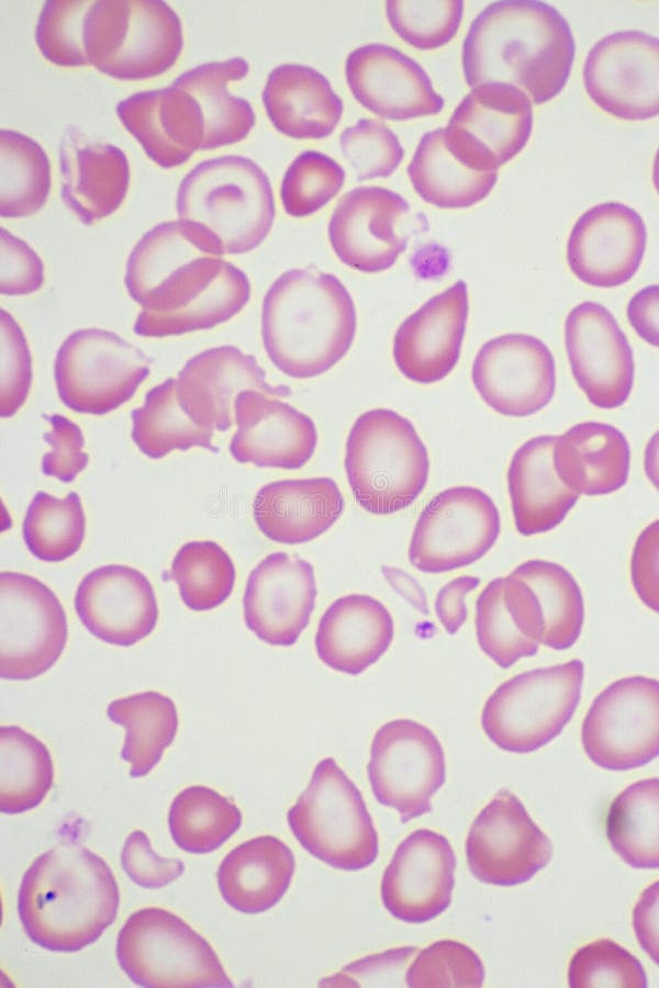 Target Cells with Abnormal Red Blood Cells in Blood Smear Stock Image ...