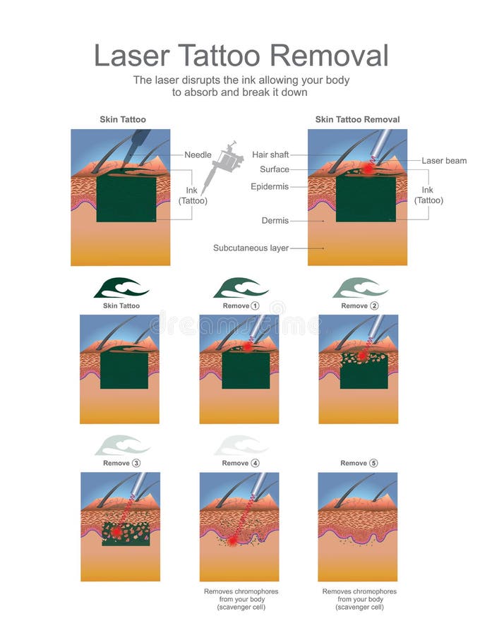 Tattoo removal stock vector. Illustration of epidermis - 93815472