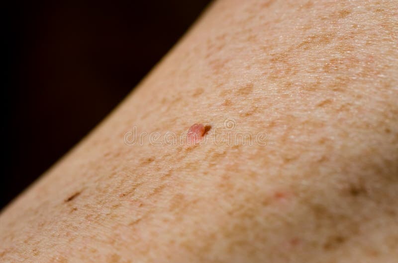 Angioma Taupe Rouge Sur Le Corps Tâche De Naissance Sur La Peau Image ...