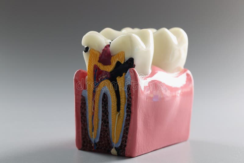 Teaching Model of a Tooth in Cross Section, Close-up Stock Photo ...