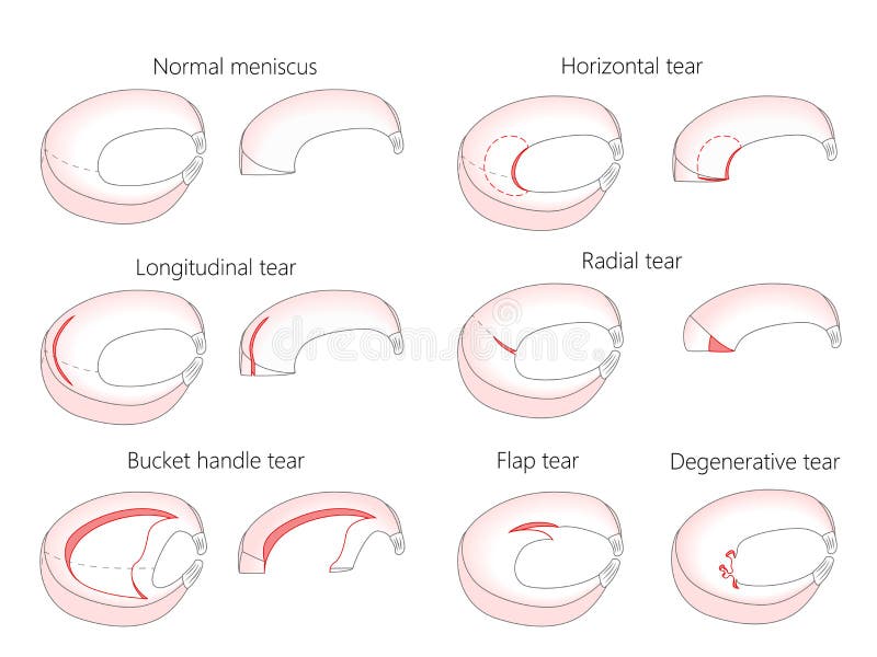 _Tear Arten des Meniskus vektor abbildung. Illustration von diagramm ...