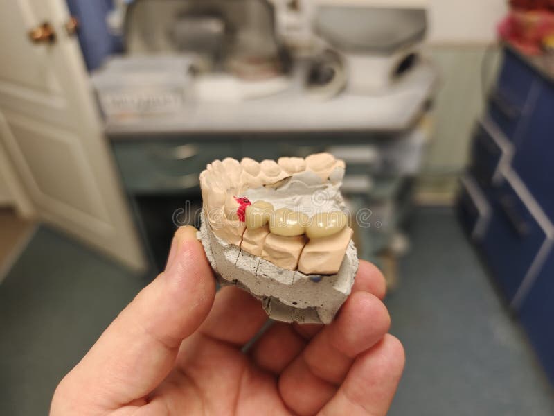 Technician Dental is Working with Complete Metal Ceramic Prosthesis ...