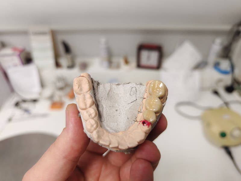 Technician Dental is Working with Complete Metal Ceramic Prosthesis ...