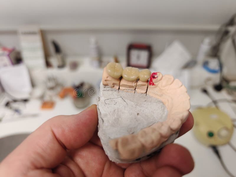 Technician Dental is Working with Complete Metal Ceramic Prosthesis ...