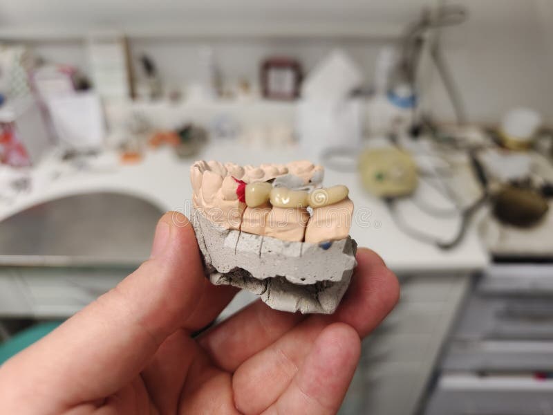 Technician Dental is Working with Complete Metal Ceramic Prosthesis ...