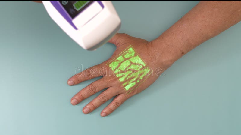 Technician Utilizing a Vein Scanner Apparatus To Visualize Veins on a ...