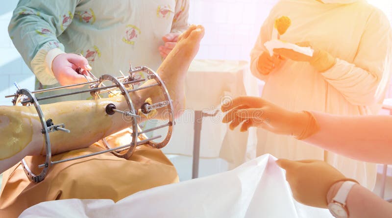 Technique of External Fixation with Rings in Orthopedic Medicine Stock ...