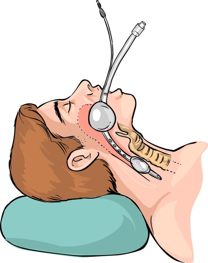 4+ Intubation Free Stock Photos - StockFreeImages