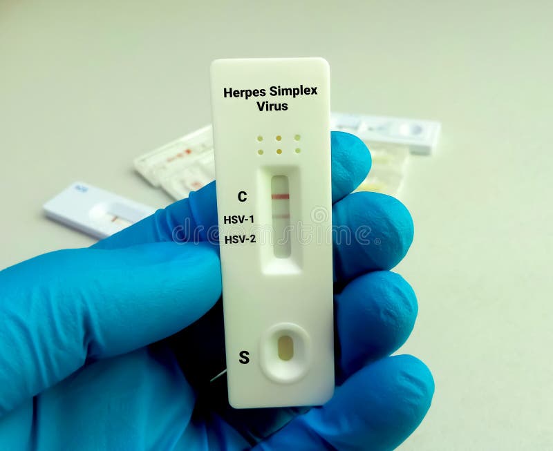 Technologist Hand Hold a Device of Herpes Simplex Virus Rapid Screening ...