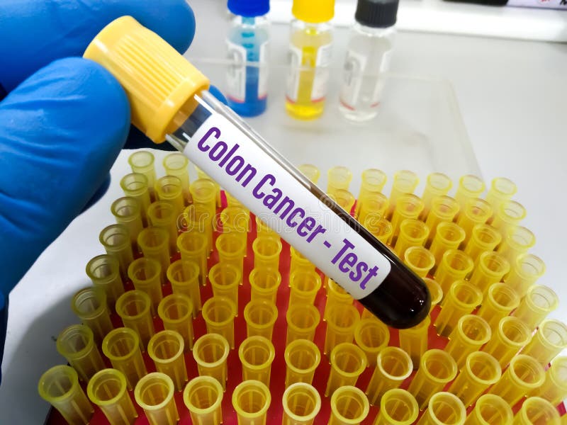 Blood Sample for Colon Cancer Test. Stock Image - Image of hepatitis ...