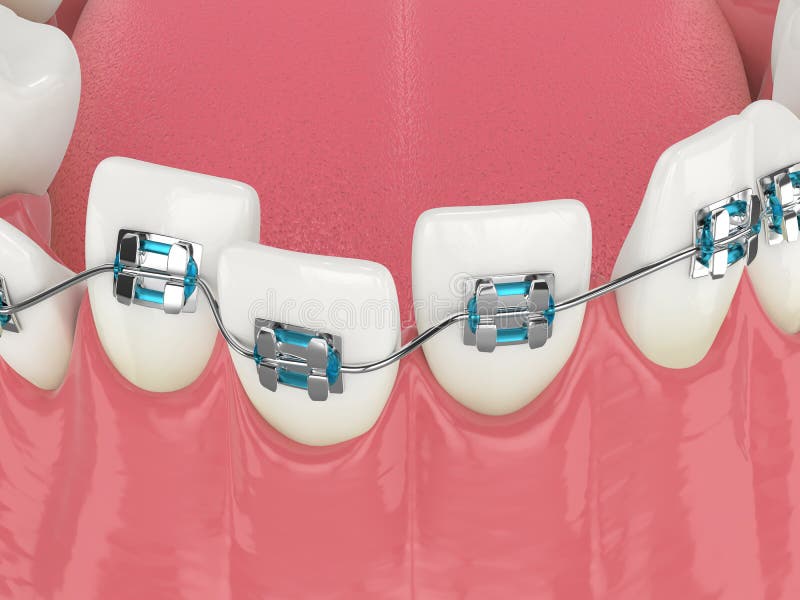 Teeth Alignment by Orthodontic Braces Isolated Over White Background ...
