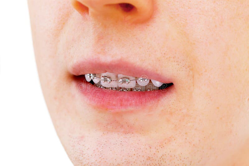 Teeth with Braces. Isolated Stock Photo - Image of metal, medical: 41170544