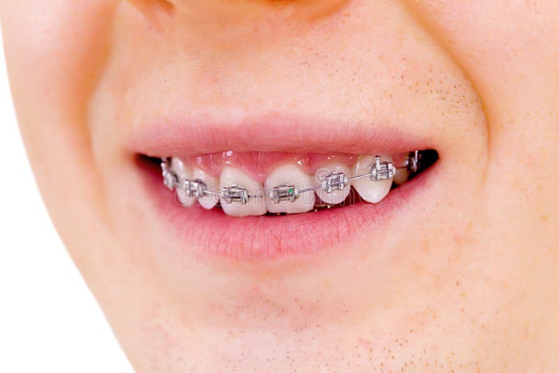 Teeth with Braces. Isolated Stock Image - Image of isolated, growth ...
