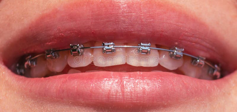 Teeth with Braces of a Smiling Girl. Macro Stock Image - Image of teeth ...