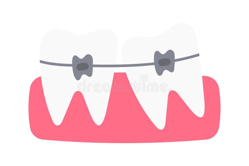Teeth with Braces, Vector Illustration. Concept of Bite Correction ...