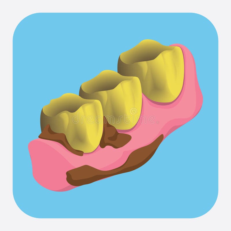 Teeth with Cavity. Vector Illustration Decorative Design Stock Vector ...