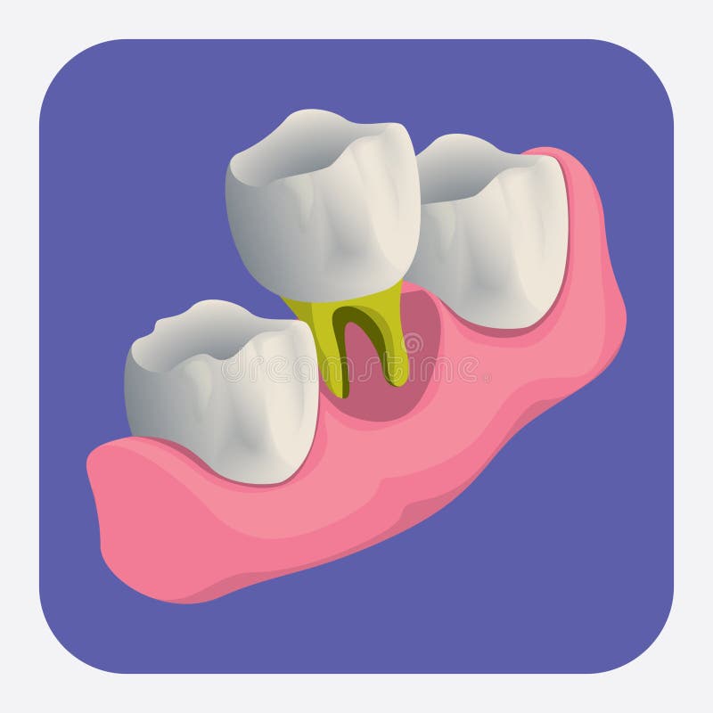 Teeth with Cavity. Vector Illustration Decorative Design Stock Vector ...