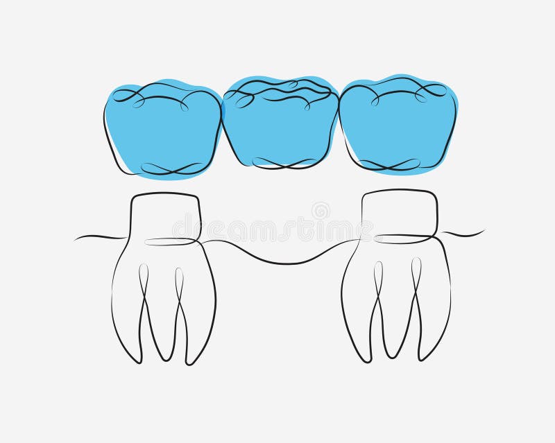 Teeth with Crown Bridge White and Blue Stock Vector - Illustration of ...