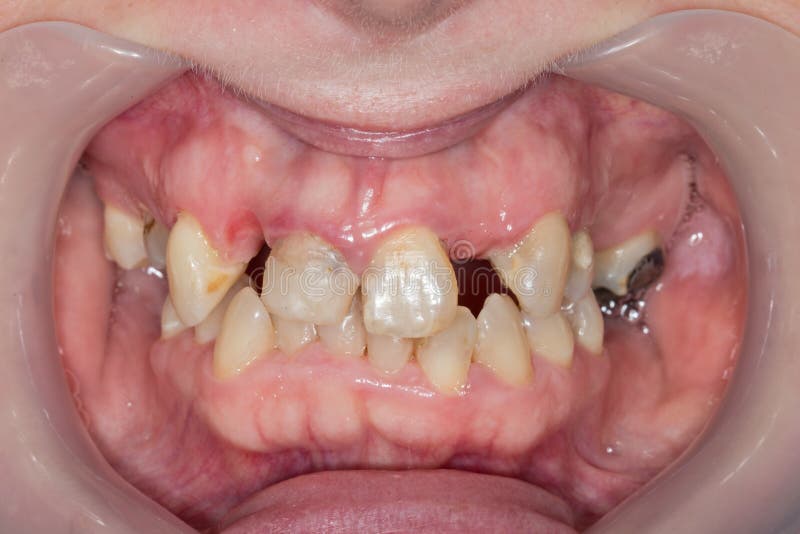 Broken teeth stock image. Image of teeth, decay, dentist - 162496189