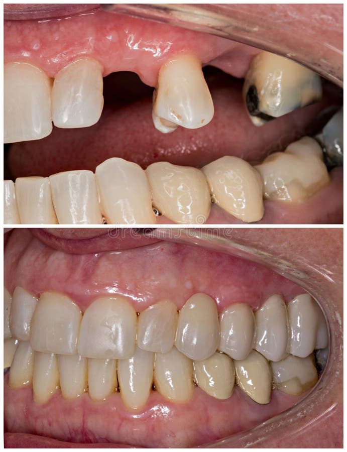 Teeth decay stock photo. Image of tooth, decay, teeth - 167770982