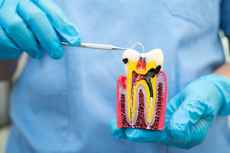 Teeth Dental Root Model with Tool for Dentist Use To Cleaning Care ...