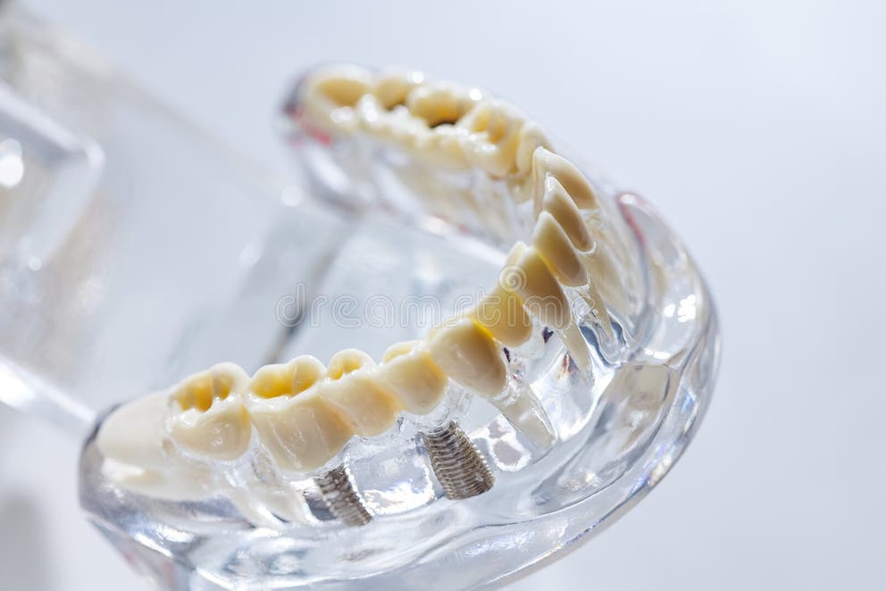 Teeth Education Model. Shallow Dof Stock Photo - Image of brace, mouth ...