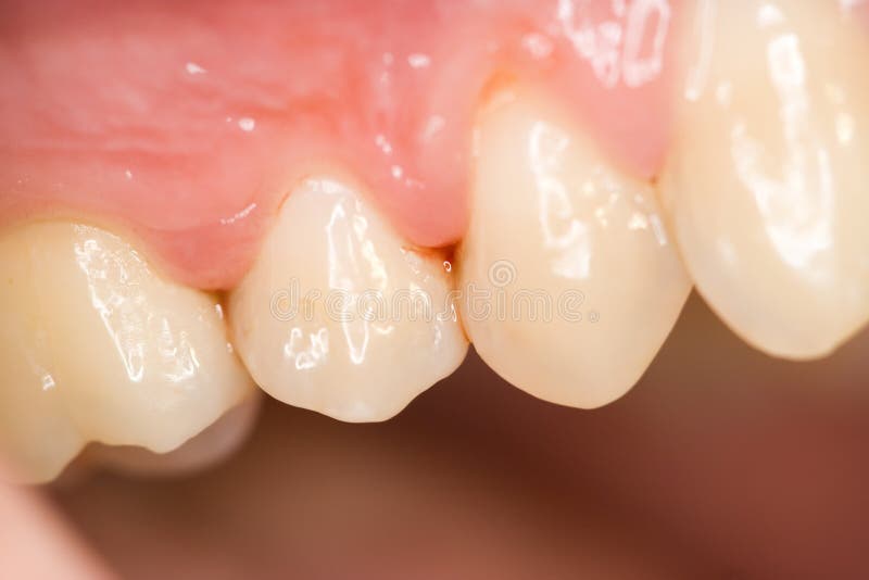 Teeth and gingivitis stock photo. Image of tools, dentistry - 14333906
