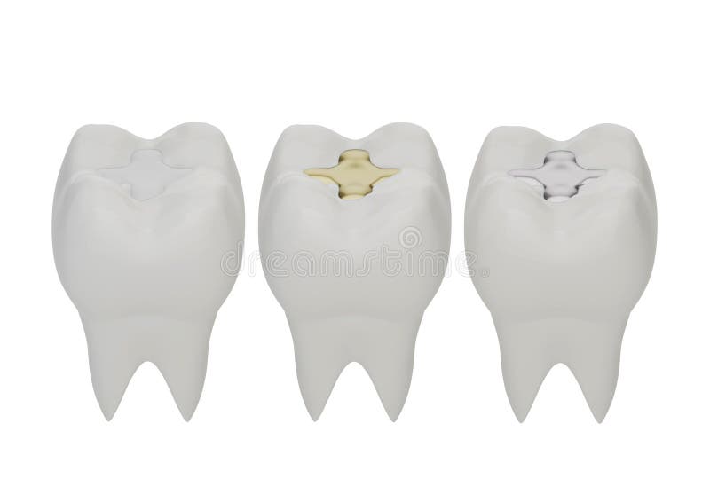 Inlay Amalgam Stock Illustrations – 87 Inlay Amalgam Stock ...