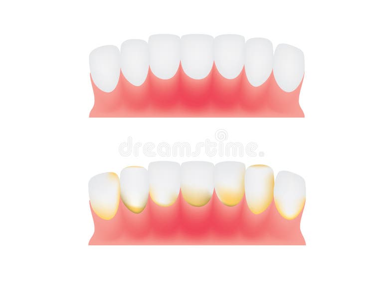 Periodontal Teeth Stock Illustrations – 2,975 Periodontal Teeth Stock ...