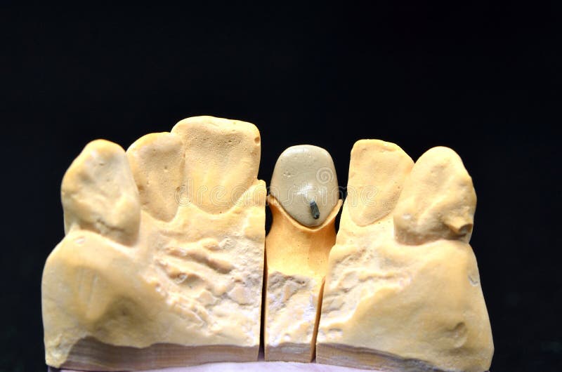 Back View of Implanted Teeth Stock Photo - Image of dental, doctor ...