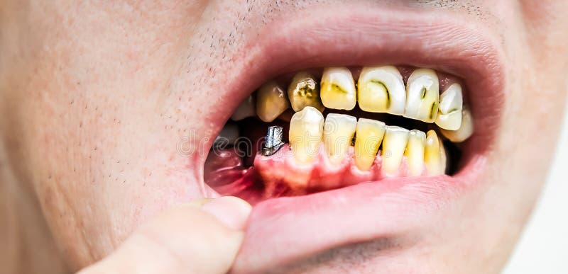 Teeth Implantation. Dental Post Preparation Stock Photo - Image of ...