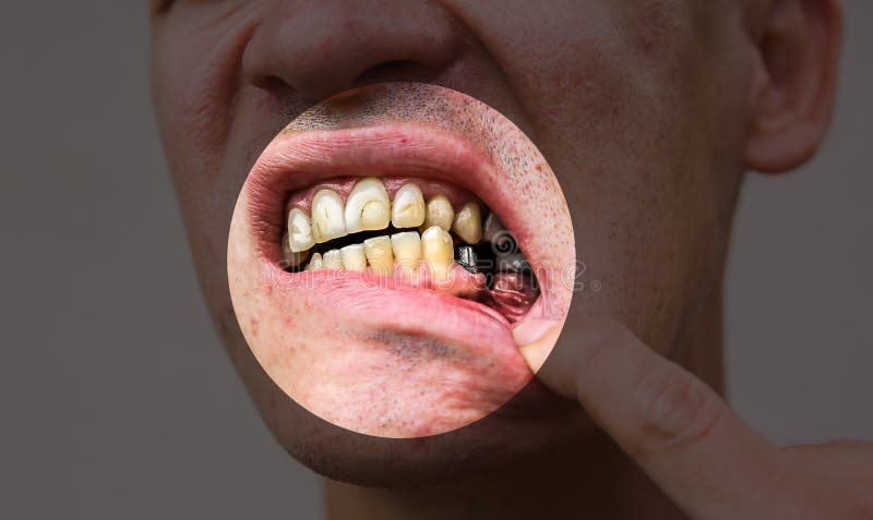 Teeth Implantation. Dental Post Preparation Stock Image - Image of ...