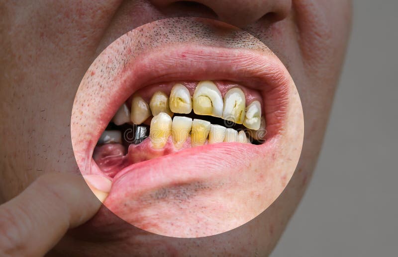 Teeth Implantation. Dental Post Preparation Stock Photo - Image of ...