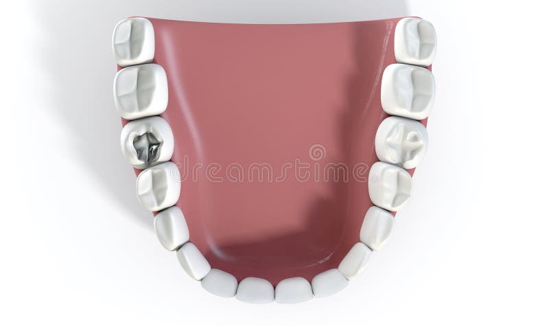 Teeth with Lead Filling stock photo. Image of hole, flesh - 56018608