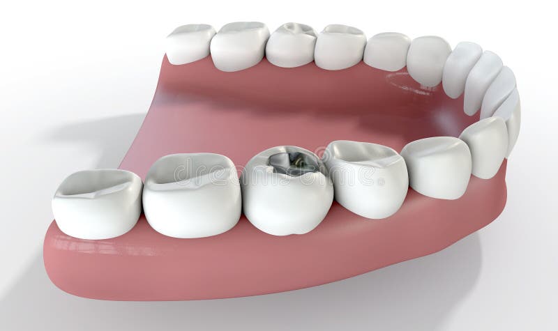 Teeth with Lead Filling stock image. Image of flesh, restore - 56018805