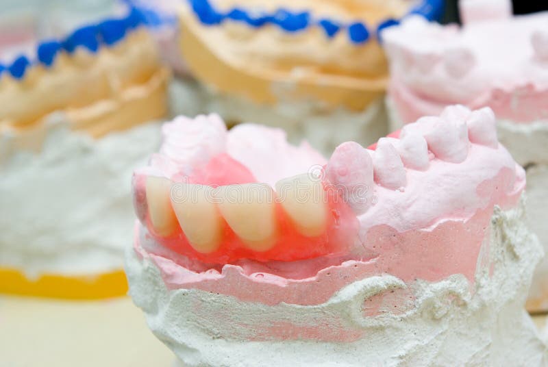Teeth Mold and Prosthetic Devices Close-up. Stock Photo - Image of ...