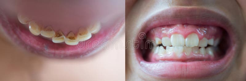 Teeth and Oral Cavities that Have Problems with Irregularly Shaped ...