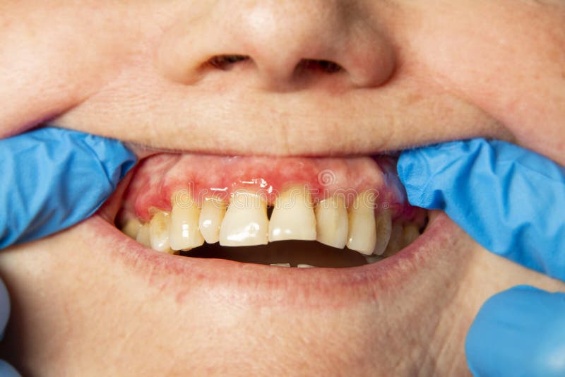 Teeth with periodontitis stock image. Image of dental - 139459439