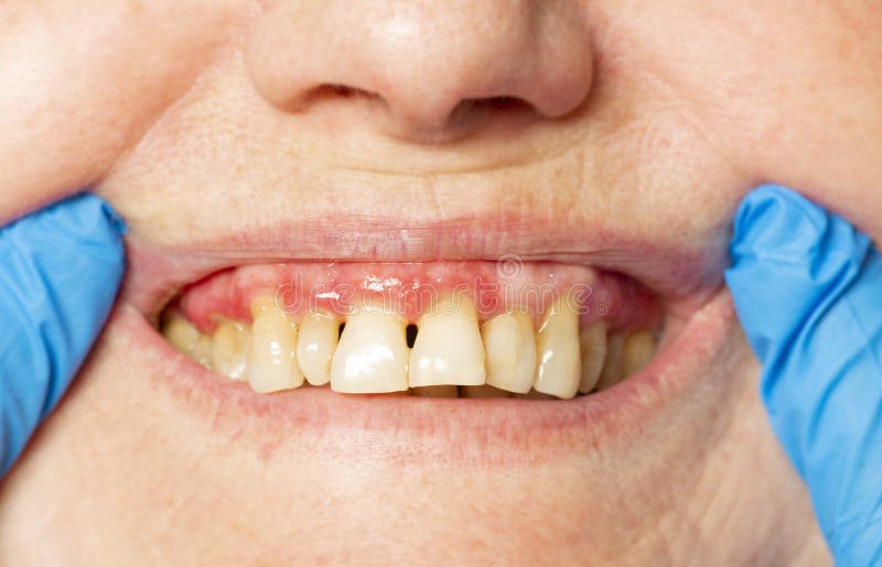 Teeth with periodontitis stock image. Image of clinic - 139459451