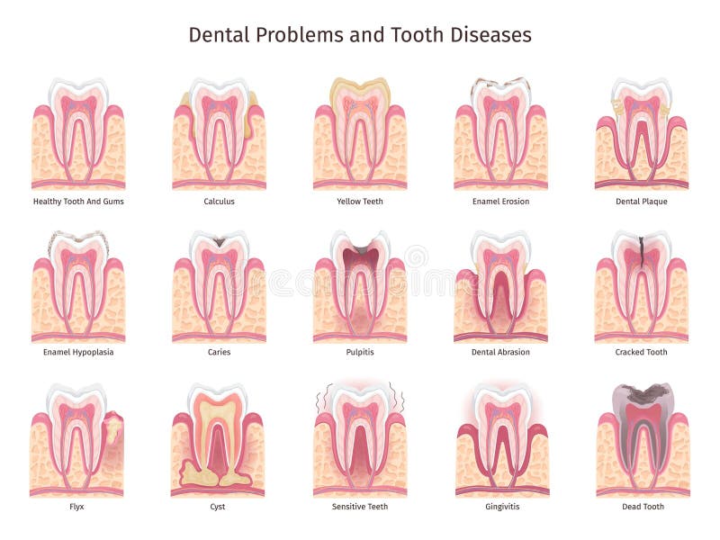 Teeth Problems Infographic. Human Tooth Decay, Oral Cavity Problem ...