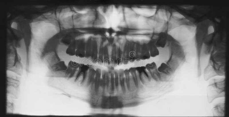 Teeth x-ray stock image. Image of scan, radiologist, lifestyle - 8300939