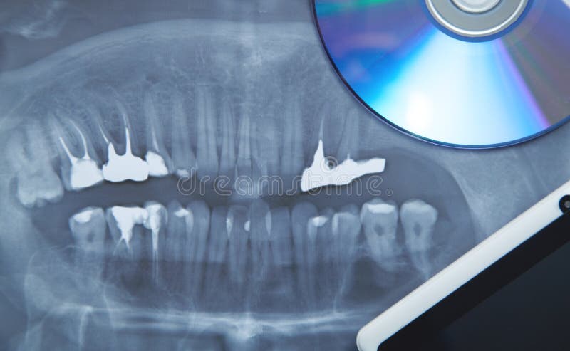 Teeth X-ray Image Tablet and Disk. Scan of Teeth Stock Photo - Image of ...